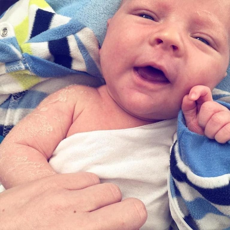 Ichthyosis {or fish-scale disease} and what it means for our little one ...