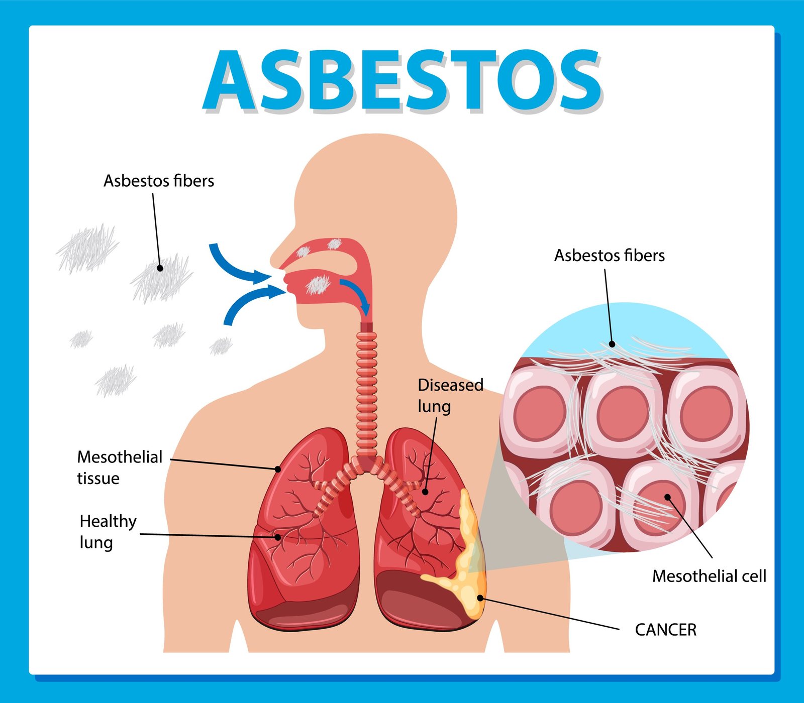 Life Expectancy with Mesothelioma